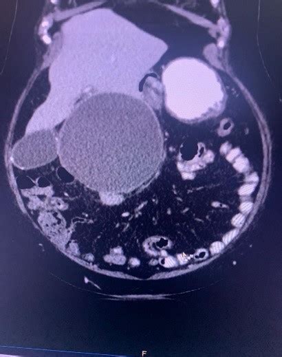 Liver Cyst Kauvery Hospital