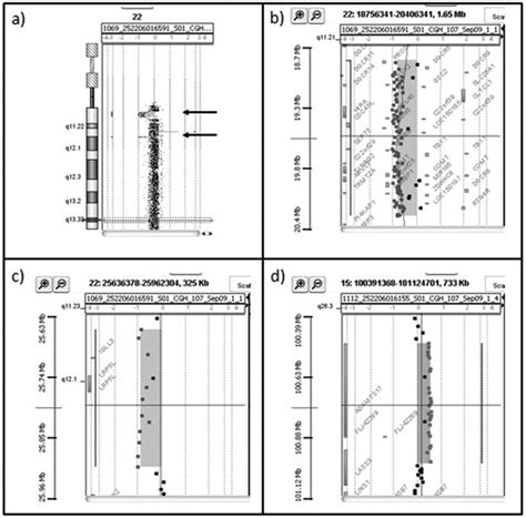 A Array Cgh Graphical Overview Of 22q1121 Deletion Large Deletion Download Scientific
