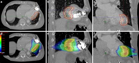 Case Ii Clinical Inner Red Contour And Planning Target Volumes