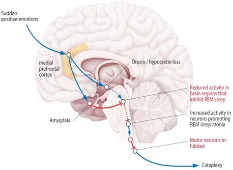 Cataplexy Practical Neurology