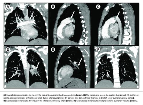 Chest Computed Tomography Scan With Contrast Download Scientific Diagram