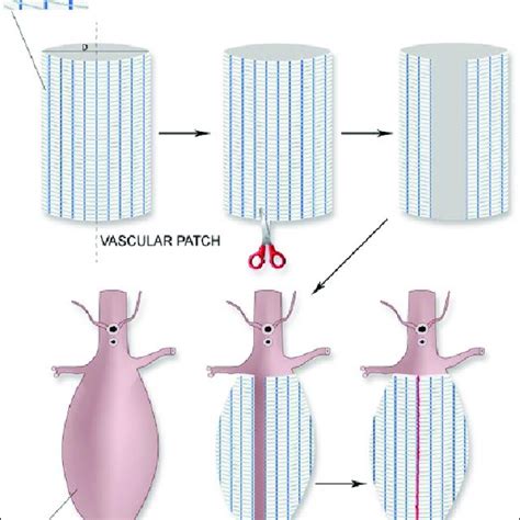 Vascular Patch Manufacturing Process Download Scientific Diagram