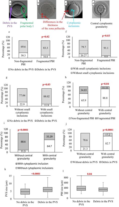 Judy Tanios On Linkedin Mature Oocyte Dysmorphisms May Be Associated