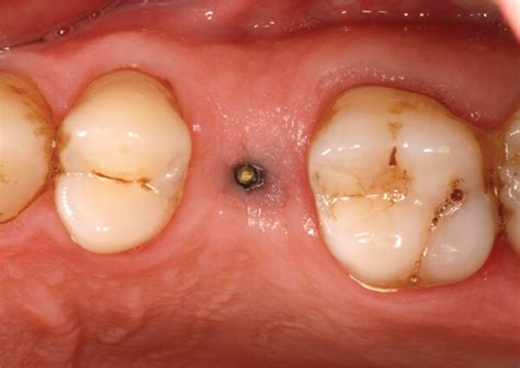 A A 10 Mm×4 Mm 3i Implant Fixture Placed B Periapical Radiograph