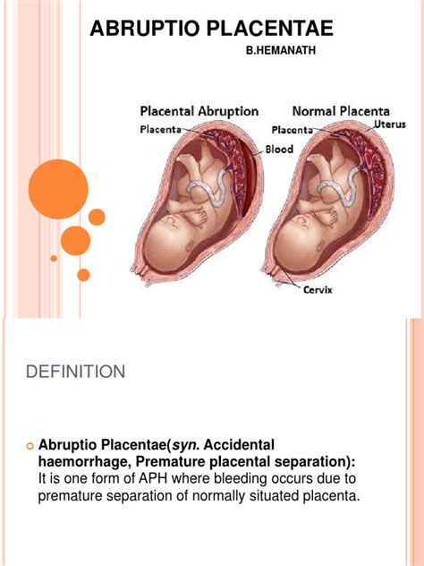 Abruptio Placentae Bhemanath Pdf Human Diseases And Disorders Rtt