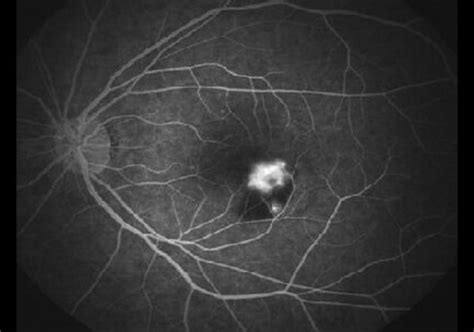 Flare Up Of Pic In Pregnancy Ffa Revealed Active Leak Open I