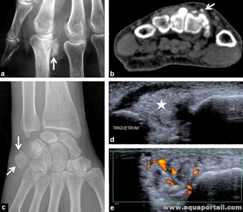 Calcification Définition Et Explications