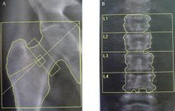 DXA Scan Errors What Can The X Ray Tech Do To Avoid Them