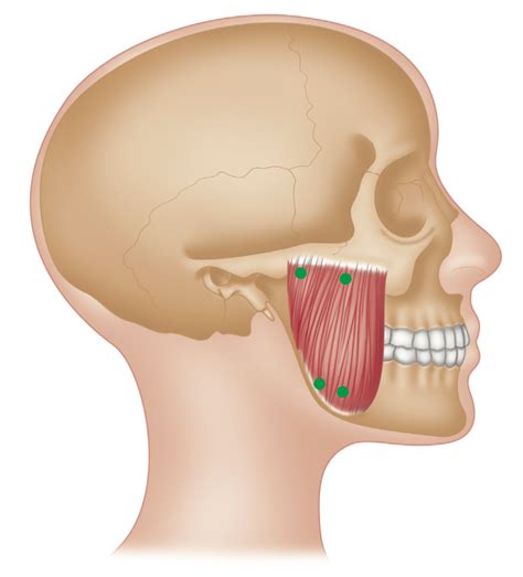 How To Find Trigger Points In The Masseter Ear And Jaw Pain Niel