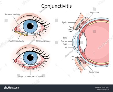 288 Eyelids Conjunctivitis Stock Vectors And Vector Art Shutterstock