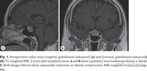 极简医学——神经节细胞瘤 知乎