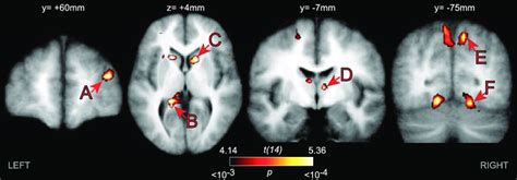 Regions Exhibiting Enhanced Activation During Associative Recall