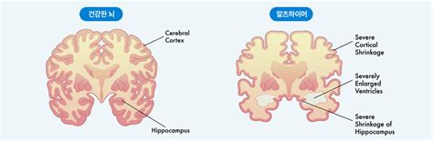 치매 종류 천문한의원구 천문한방병원