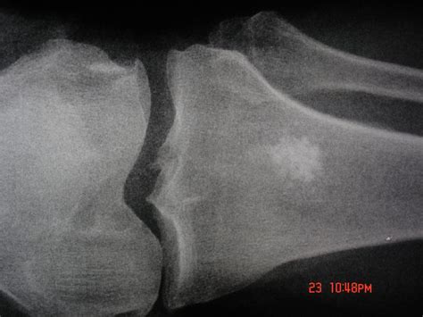 Msk Distal Femoral Cortical Defect Or Non Ossifying Fibroma And