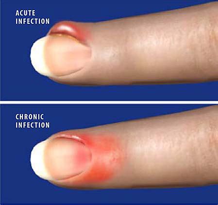 Chronic Paronychia Home Treatment