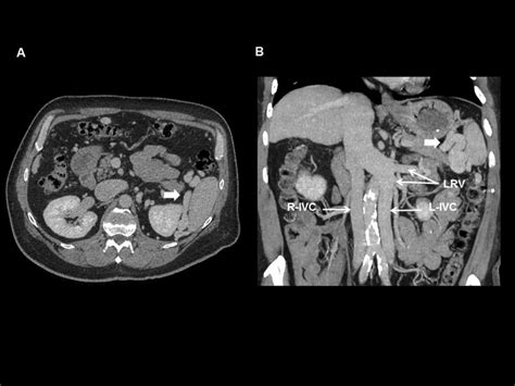 Preoperative Ct Images A Large Spontaneous Srs Arrow B The