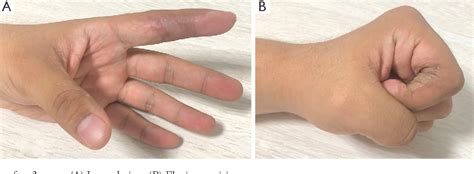 Figure 1 From Fibro Osseous Pseudotumor Of The Digit A Case Report Semantic Scholar