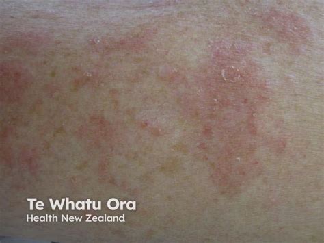 Interstitial Granulomatous Dermatitis Image