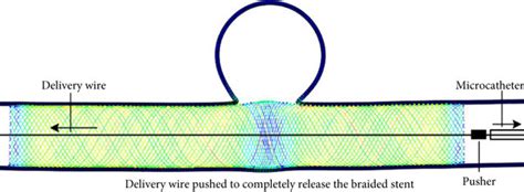 Deployment Procedure Of Flow Diverter With Compaction Download