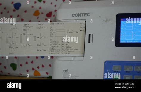 Ecg Machine Display And Print Out Chart Indicating Hearts Electrical Activity Stock Video