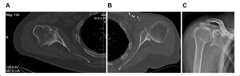 Two Cases With A Very Different Glenoid Morphology And Bone Defect From