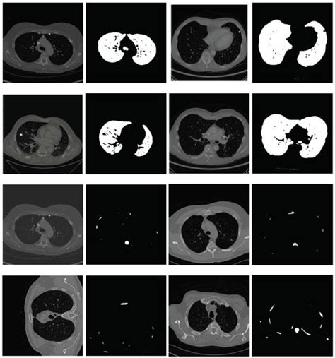 optimal thresholding for multi window computed tomography ct to