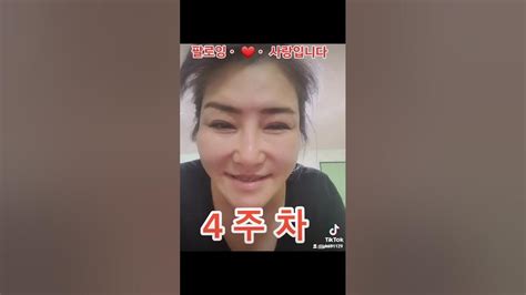 얼굴 리프팅 주름제거 4주차 테이핑ㆍ 아직까진 프부 트러블 없구요 일주일뒤 경과보고 하겠습니다 성형않하고 미간ㆍ팔자주름 ㆍ마리오네뜨 주름 없앨수있을까실험중입니다 Youtube