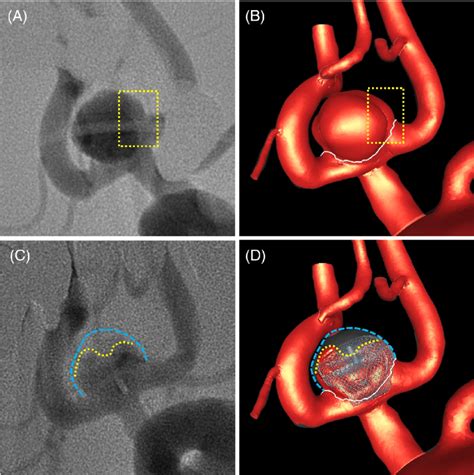 Qualitative Comparison Of Cfd Results And In Vivo Dsa Angiograms Before