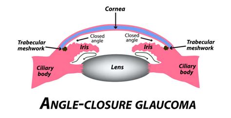 Glaucoma Nurses Revision