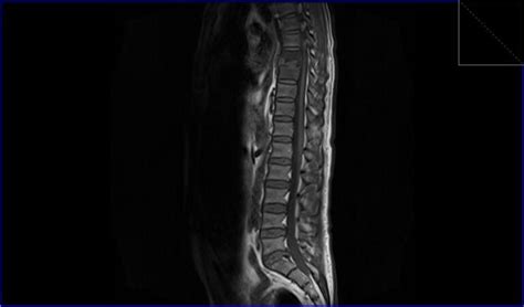Discitis Mri Radiology Article On How To Report Spondylodiscitis Discitis Mri Radiology Article On How To Report Spondylodiscitis