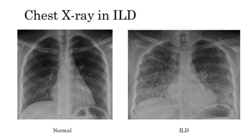Pulmonary Fibrosis And Hp Extrinsic Allergic Alveolitis Flashcards Quizlet