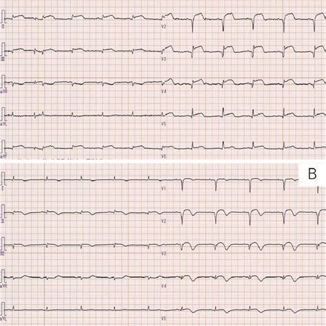 A The Electrocardiogram Ecg Shows St Segment Elevation B On Her
