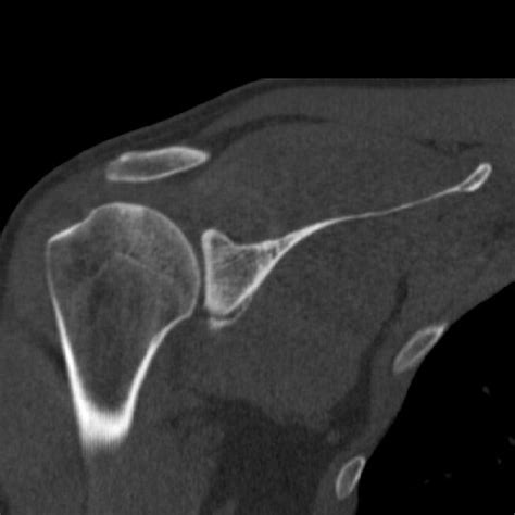 Bankart Lesion Mri Remplissage Austin Tx Shoulder Arthroscopic