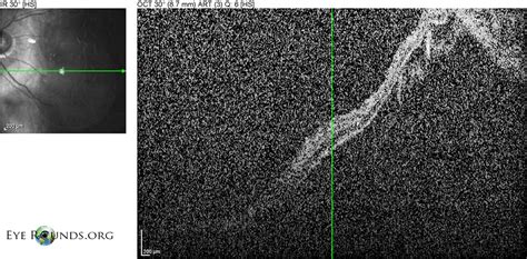 Atlas Entry Rhegmatogenous Retinal Detachment Macula Off