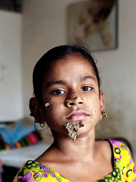 Tree Man Before And After