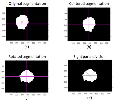 Artificial Intelligence Algorithms For Benign Vs Malignant Dermoscopic Skin Lesion Image