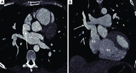 Sinus Venosus Atrial Septal Defect With Anomalous Pulmonary Venous