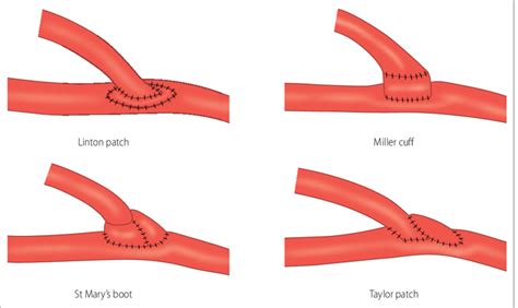 6 Distal Anastomosis Adjunctive Procedures A Linton Patch B