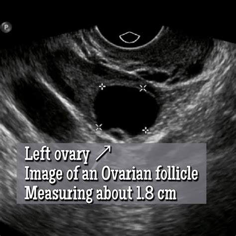 Ovarian Follicle Vs An Ovarian Cyst How To Tell The Difference Ultrasoundfeminsider