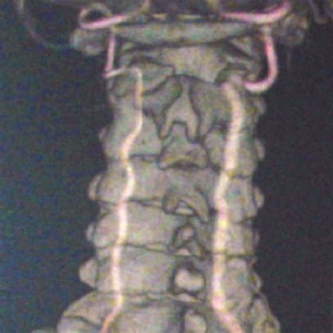 Three Dimensional Computed Tomography Showing Congenital Defect In Pars Download Scientific