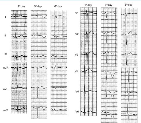 Figure 3 From Electrocardiographic Findings In Takotsubo Cardiomyopathy