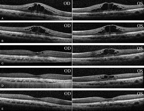 Serial Images Of Optical Coherence Tomography OCT Of This 60 Year Old Download Scientific