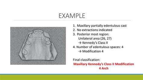 Kennedys Classification In Cast Partial Denture Pptx Dental Health