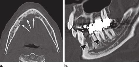 Osteoradionecrosis Of The Mandible Workup Laboratory