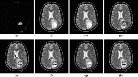 image set 2 a ct input b mri input c bfif [22] d ffif [18] e gfsf [19