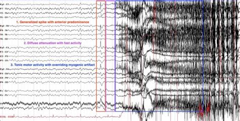 Abnormal Eeg Results Light