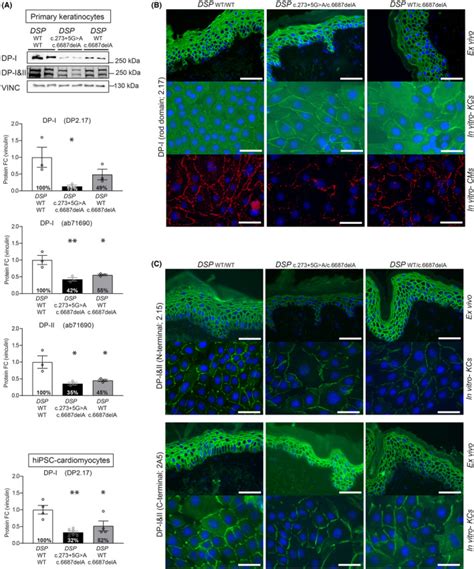 Functional Investigation Of Two Simultaneous Or Separately Segregating DSP Variants Within A