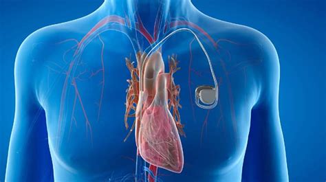 Pacemaker Surgery In India Causes Procedure Hospitals