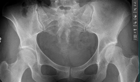 Hairline Fracture Hip Symptoms