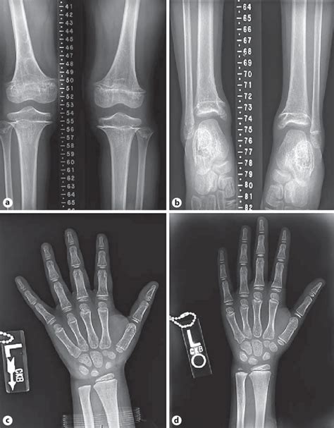 Radiographs Of The Knee A And Ankles B At Age 84 Years